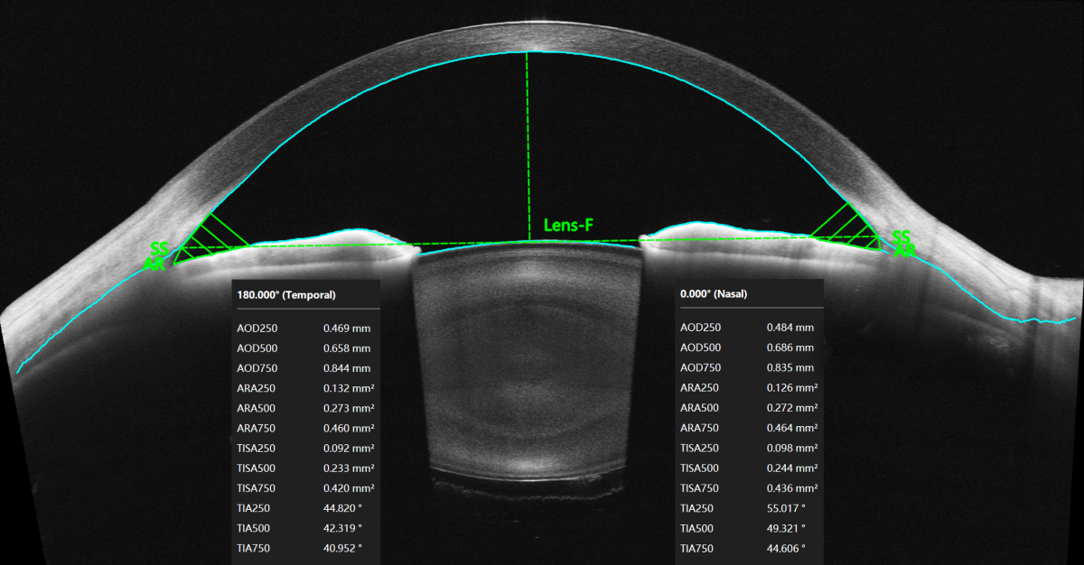 ACA & ONH – Intalight