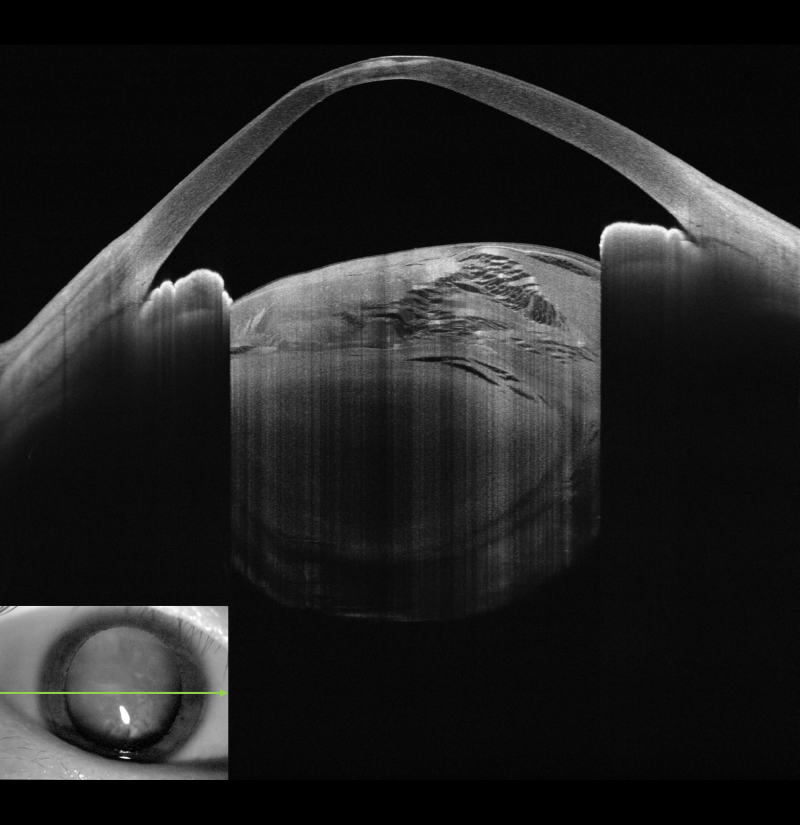 DREAM OCT™ – Intalight