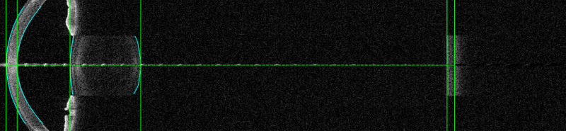 Anterior Segment – Intalight