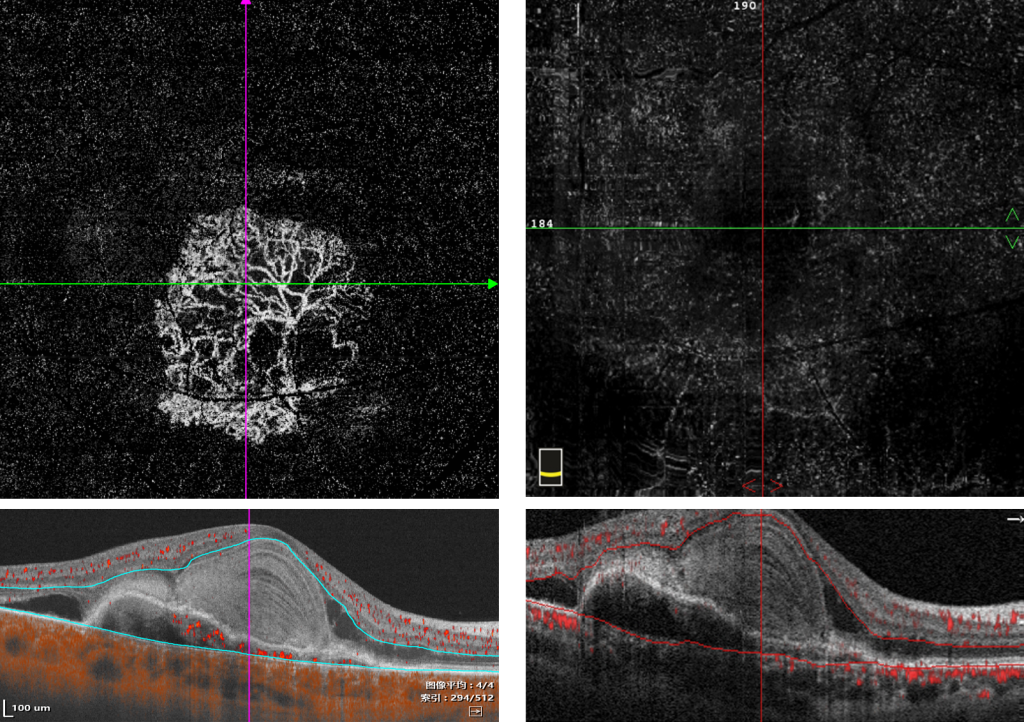 Retina & Vitreous – Intalight