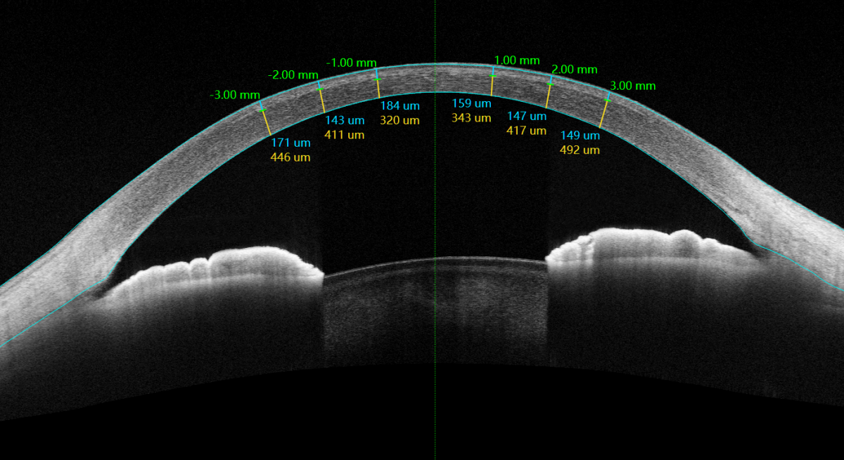 Anterior Segment – Intalight