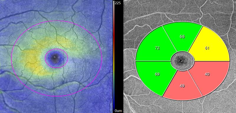 ACA & ONH – Intalight