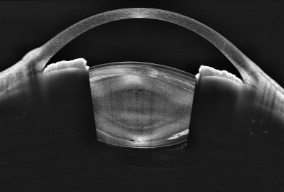 Anterior Segment – Intalight