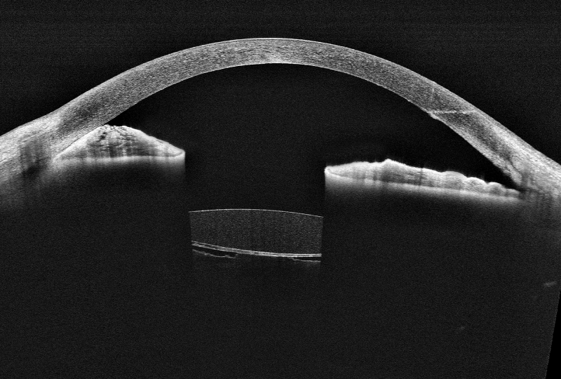 Anterior Segment – Intalight