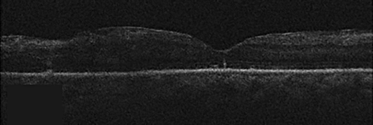 Retina & Vitreous – Intalight