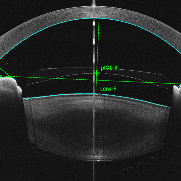 如意全眼OCT – Intalight