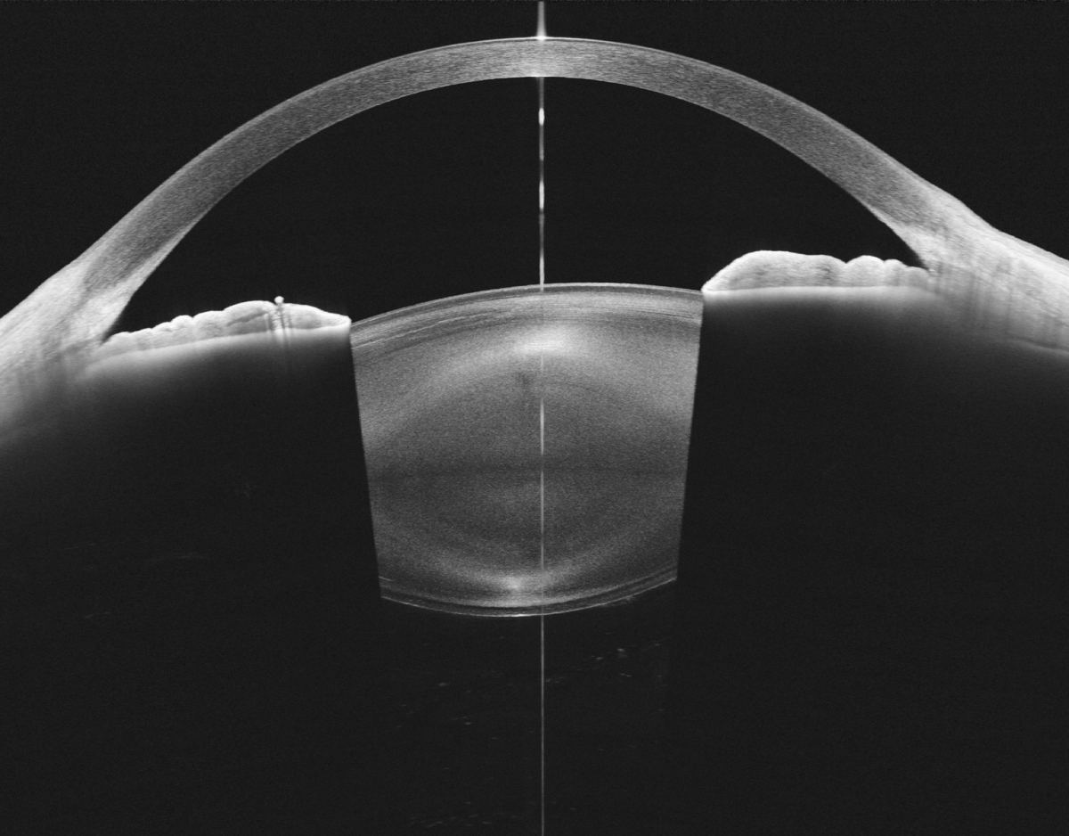 如意全眼OCT – Intalight