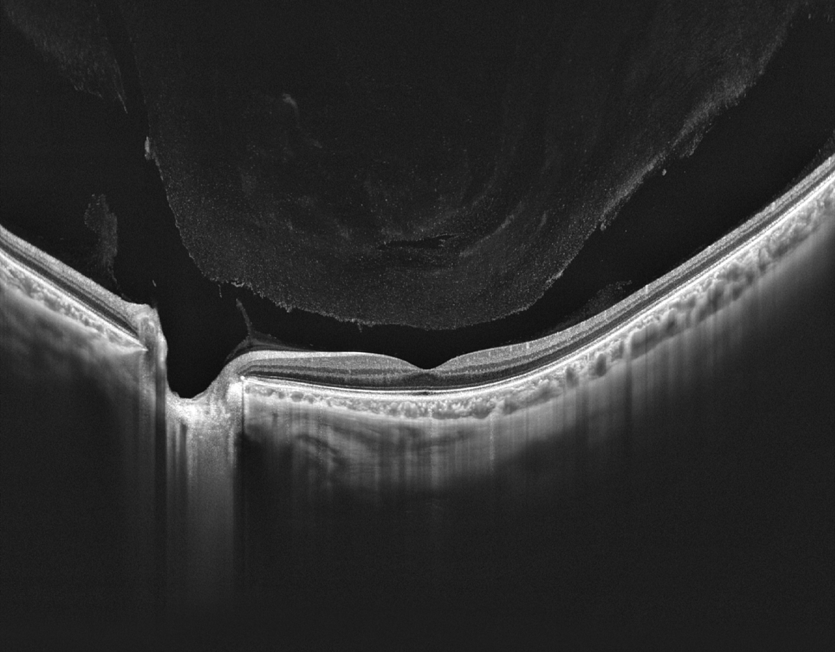 DREAM OCT™ – Intalight