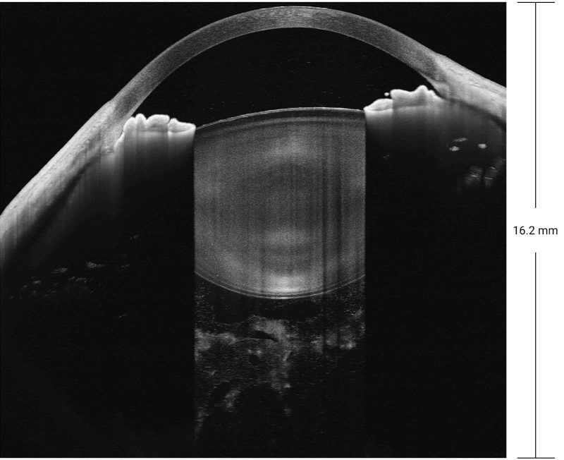 DREAM OCT™ – Intalight